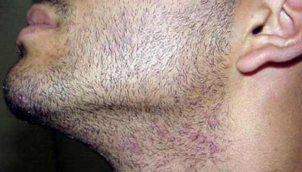 Foliculitis en la barba: ¿Qué es? ¿Como evitar? ¿Cómo tratar? | New Old ...
